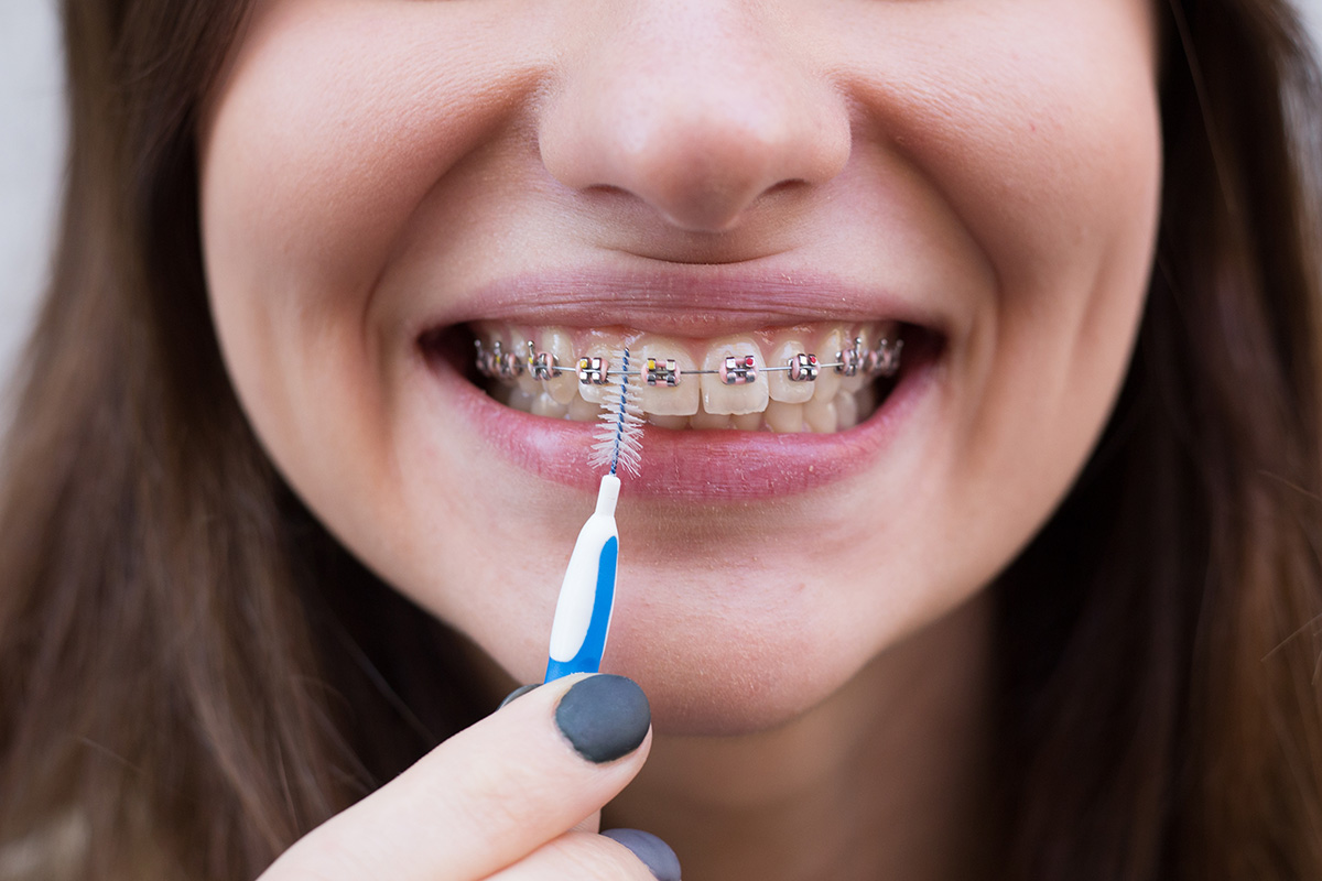 ¿Qué son los cepillos interdentales y para qué sirven? - Bayo Martín Dental